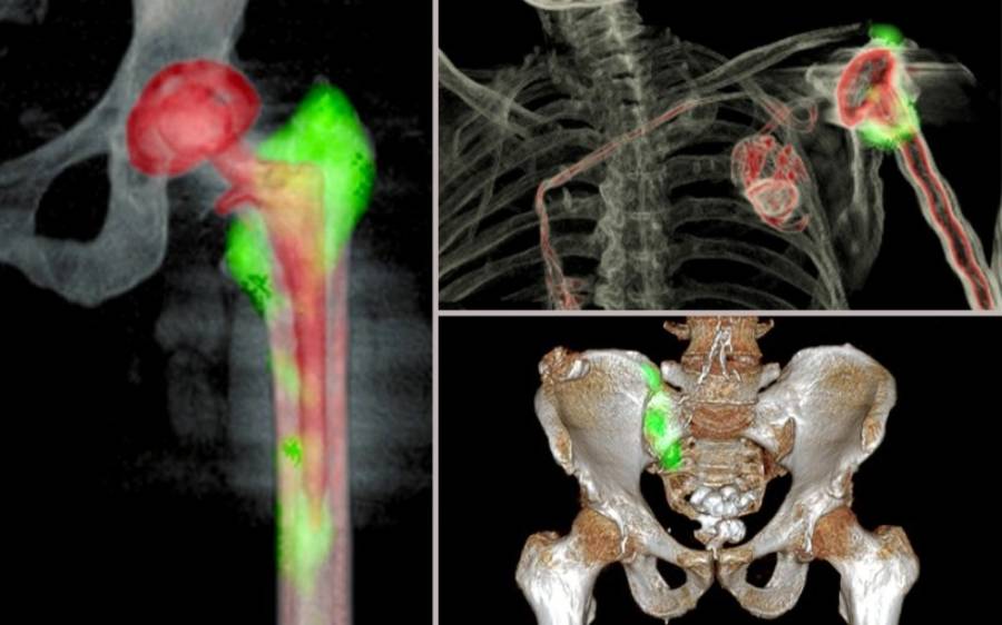 Avance en el diagnóstico con el SPECT-TAC | Tu canal de salud