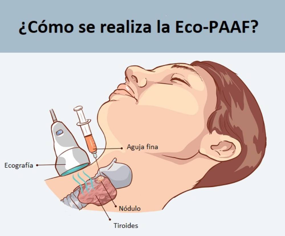 Todo sobre la prueba Eco-PAAF de tiroides | Tu canal de salud